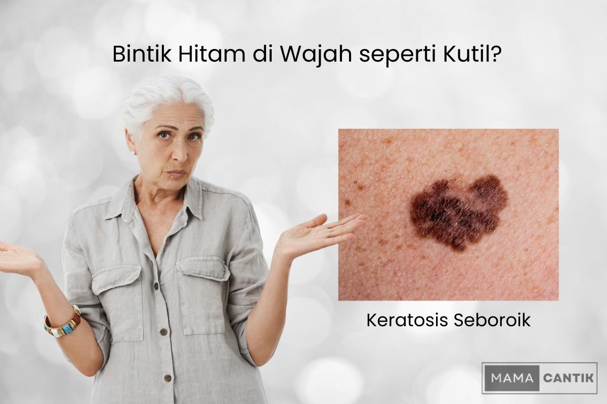 Cara Menghilangkan Bintik Hitam di Wajah Seperti Kutil