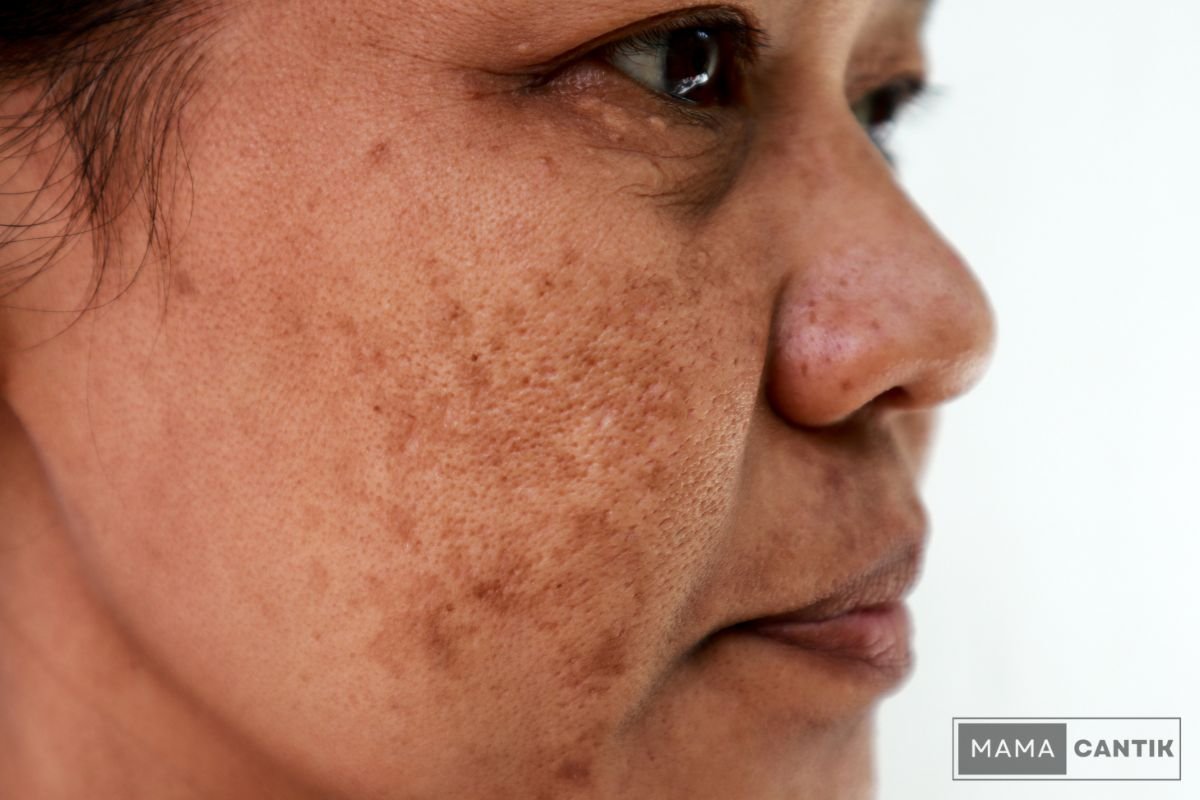 Bintik Hitam di Wajah: Penjelasan, Penyebab, Cara Mengatasi
