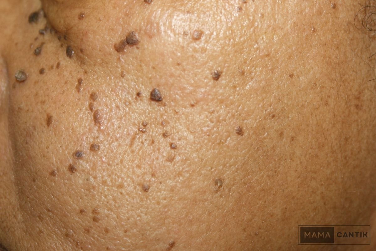 Cara Menghilangkan Bintik Hitam di Wajah Seperti Tahi Lalat