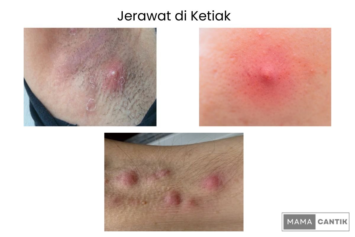 Jerawat di Ketiak: Ciri, Penyebab, Cara Mengatasinya