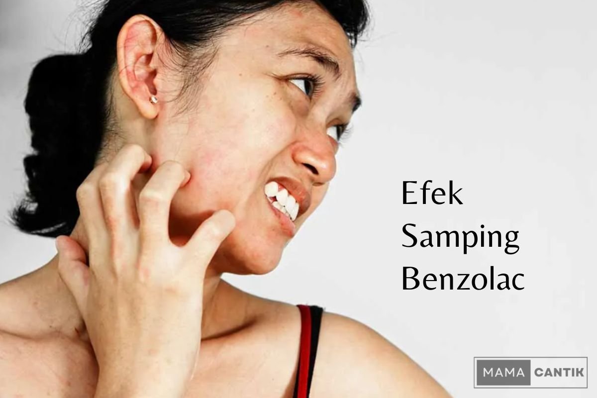 Benzolac untuk Jerawat: Manfaat, Dosis, dan Efek Samping