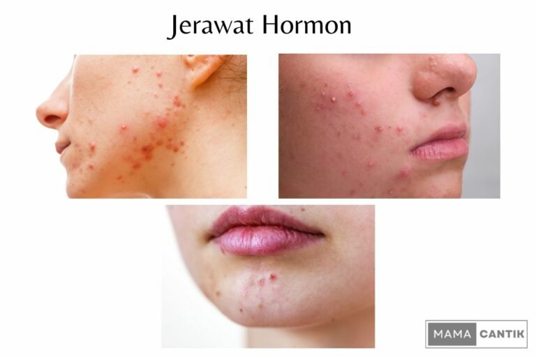 Jerawat Hormon: Ciri-Ciri, Penyebab, Obat, Cara Mengatasi