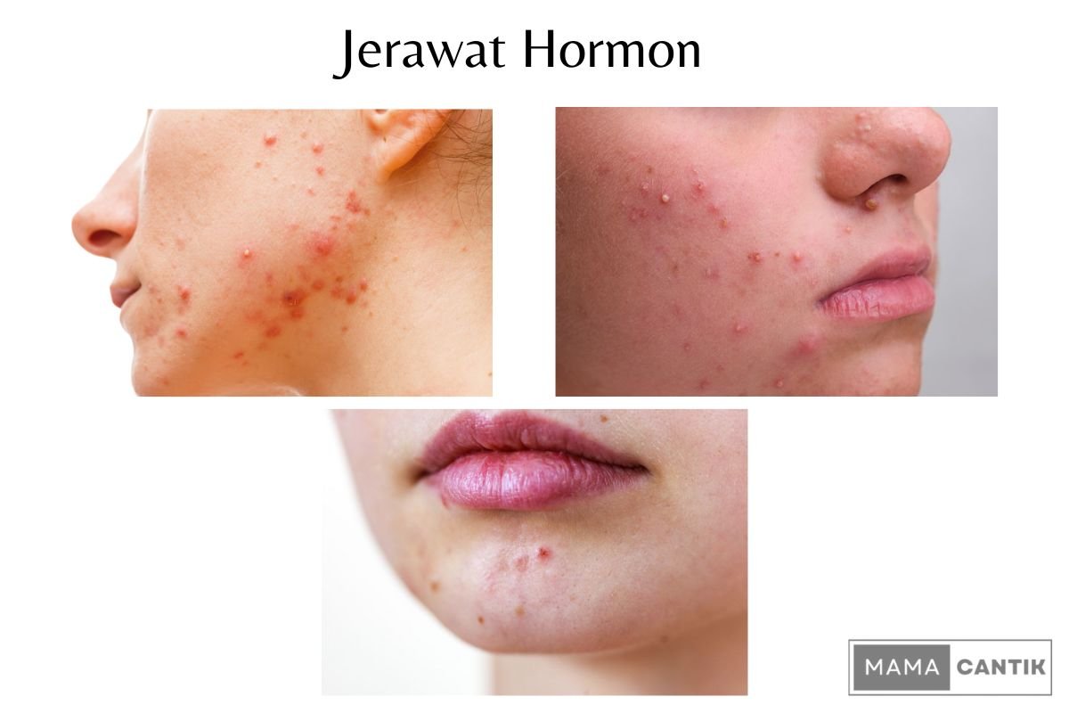 Jerawat Hormon: Ciri-Ciri, Penyebab, Obat, Cara Mengatasi