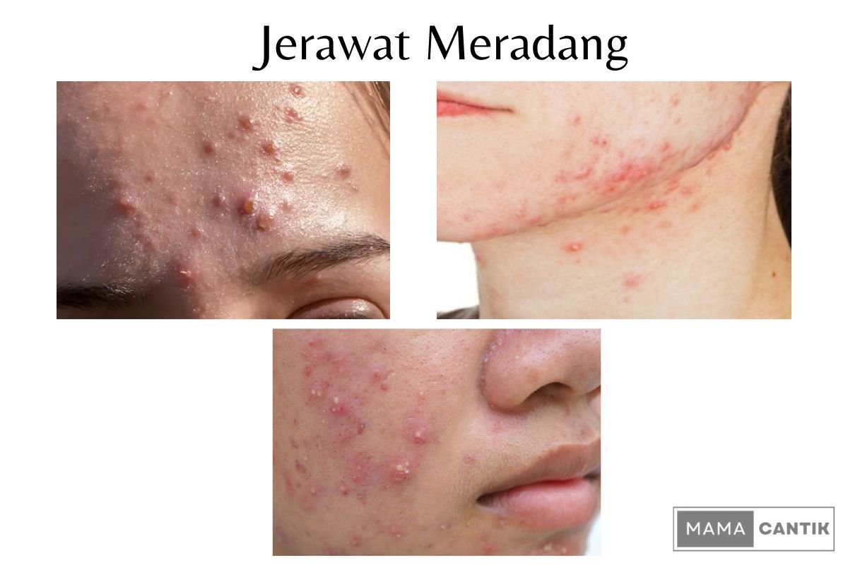 Jerawat Meradang: Ciri-Ciri, Penyebab, Obat, Cara Mengatasi