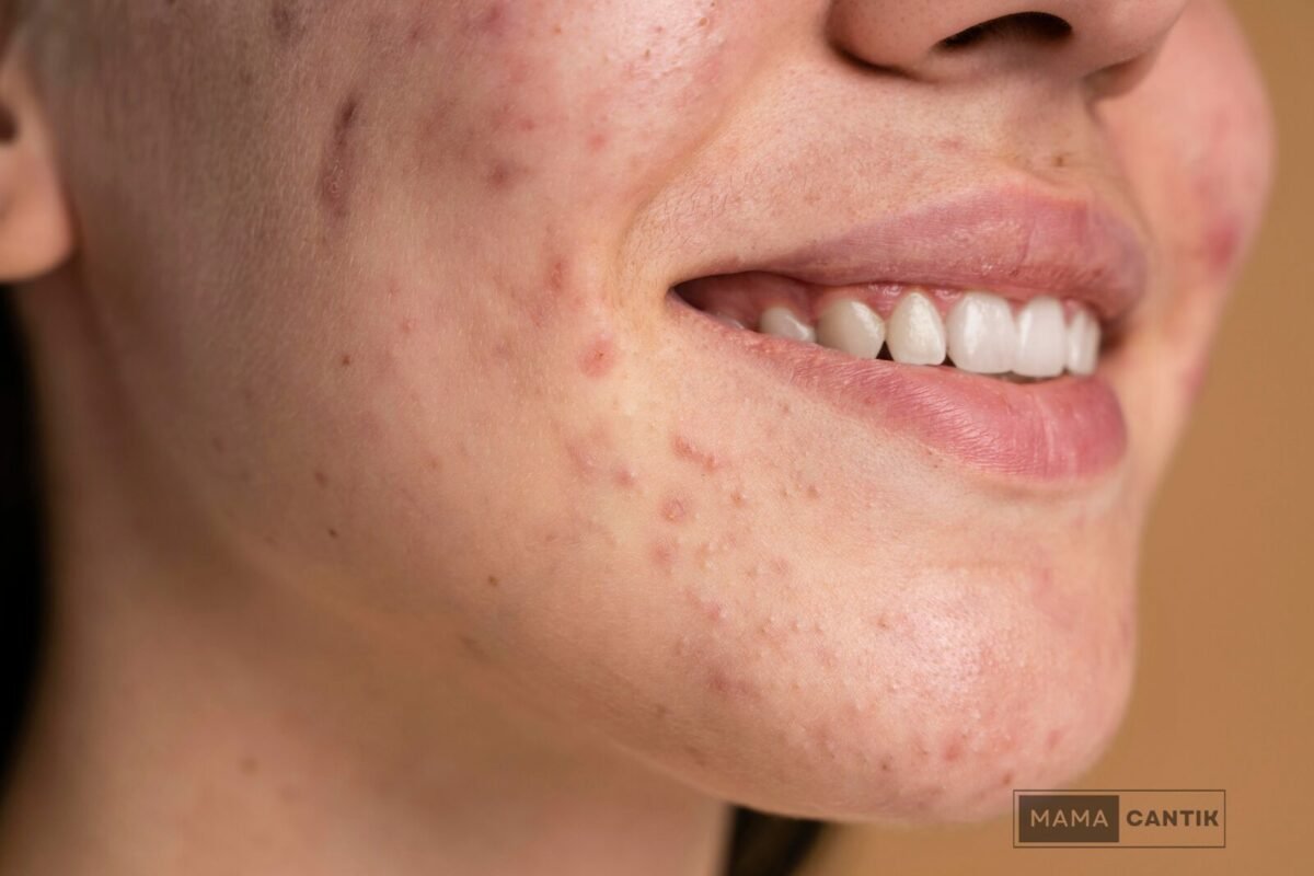 3 Jenis Jerawat Beserta Gambar, Penyebab, Cara Mengatasi