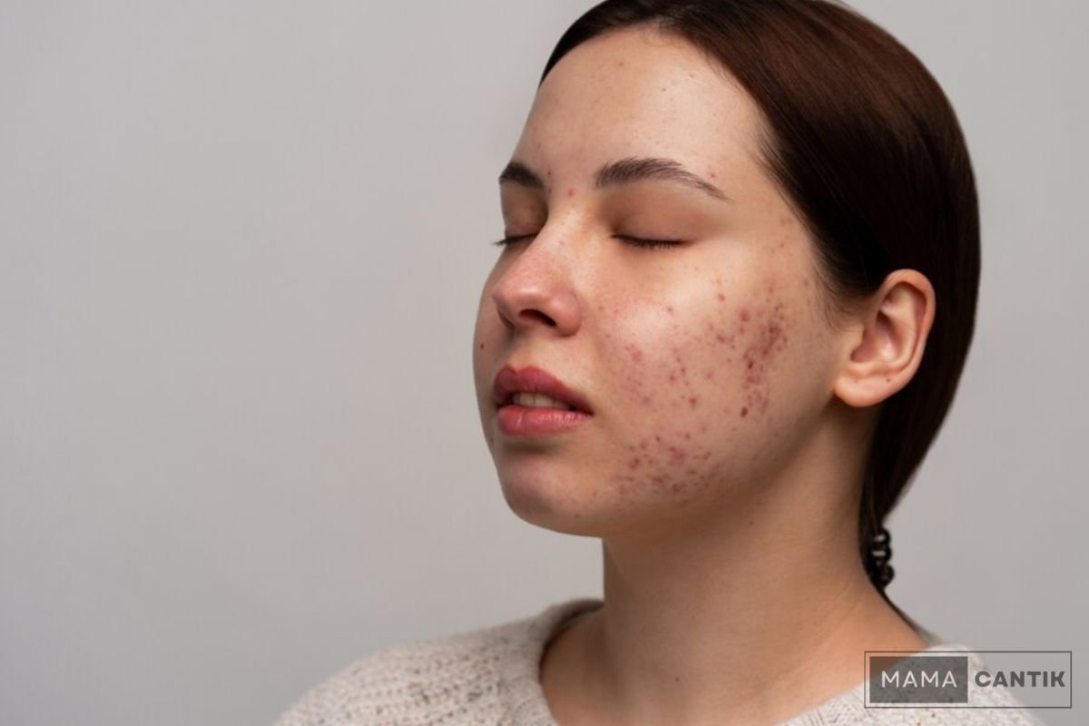 Jerawat Hormon: Ciri-Ciri, Penyebab, Obat, Cara Mengatasi